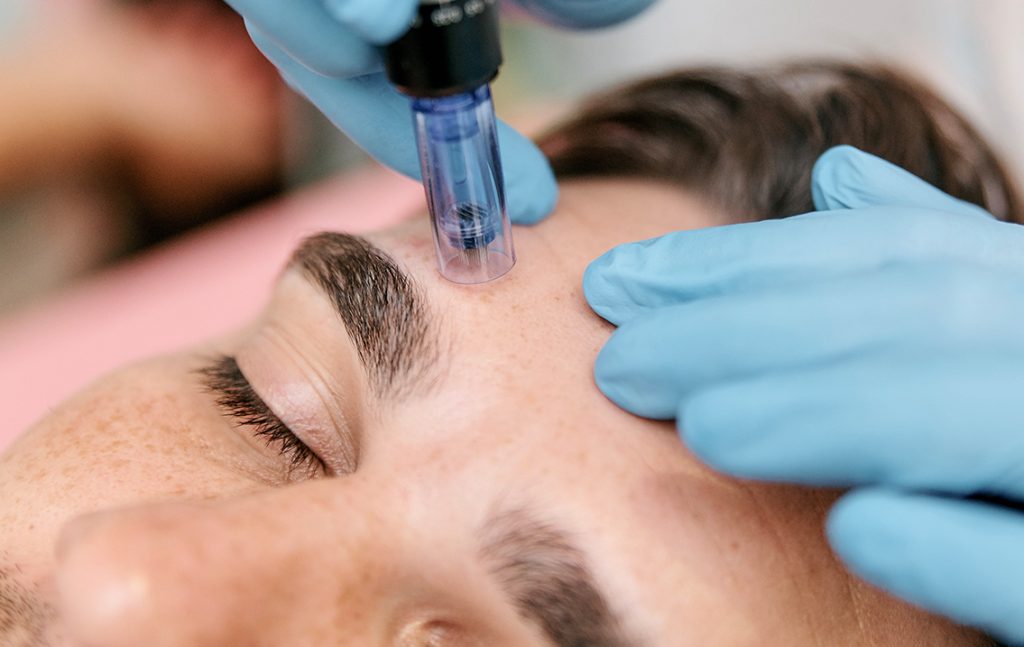 Microneedling with Exosomes – Beyond Med Spa & Wellness Center